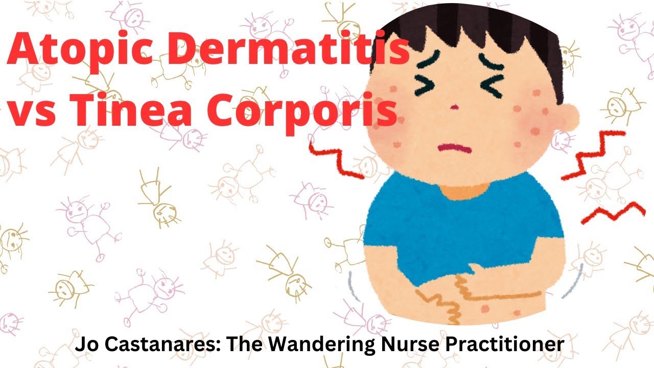 ⛑️ Atopic Dermatitis (Eczema) vs Tinea Corporis (Ringworm); # ...