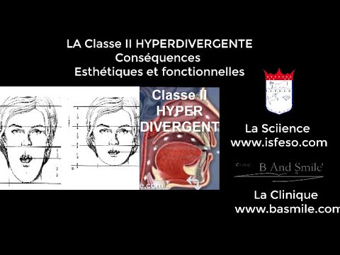 La Classe II Hyperdivergente en Orthodontie : Esthétique et Fonction ...