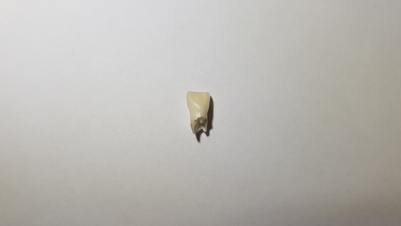 How to Pull Out a Loose Tooth | Painless Baby Tooth Extraction - YouTube