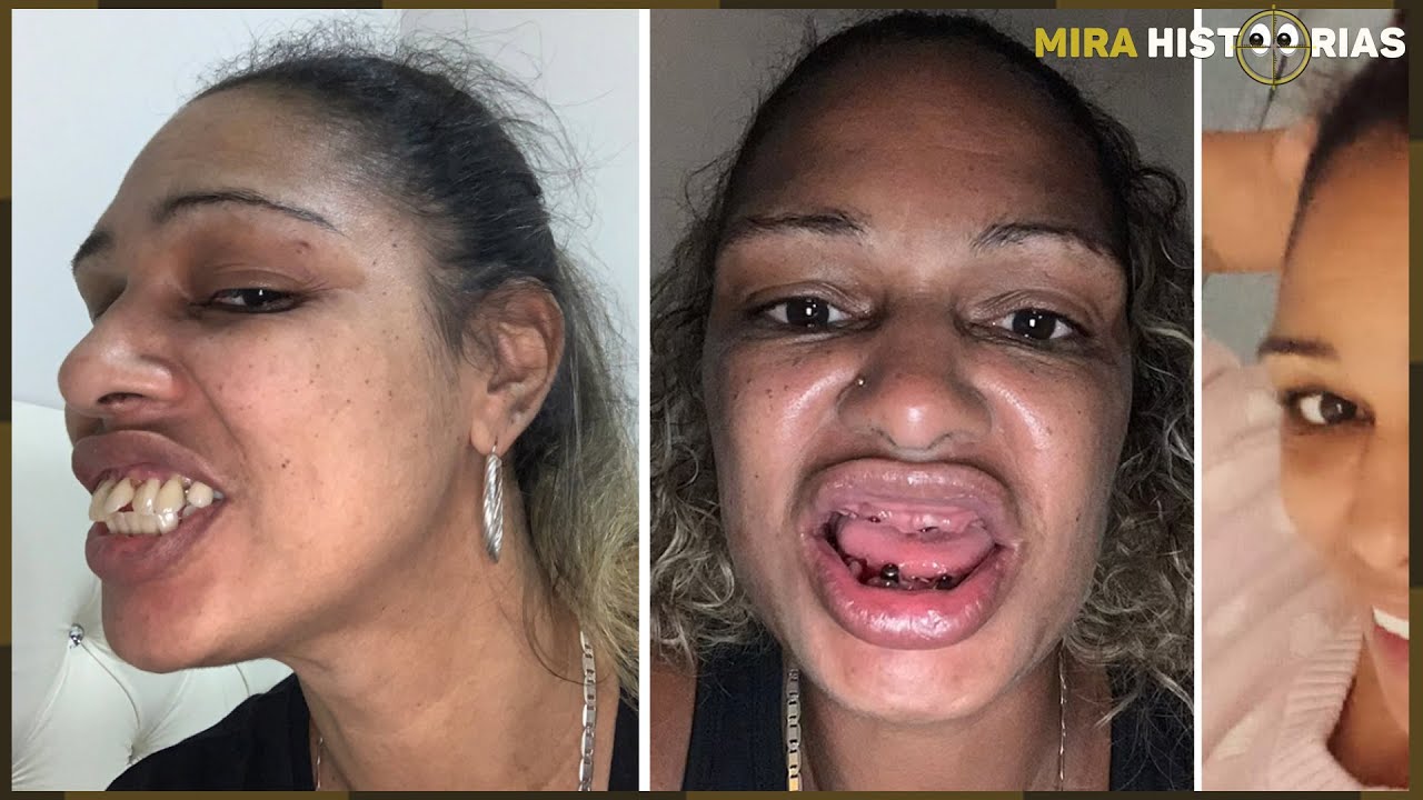 Mulher vai à Turquia tratar os dentes e volta banguela para casa. Mas o ...