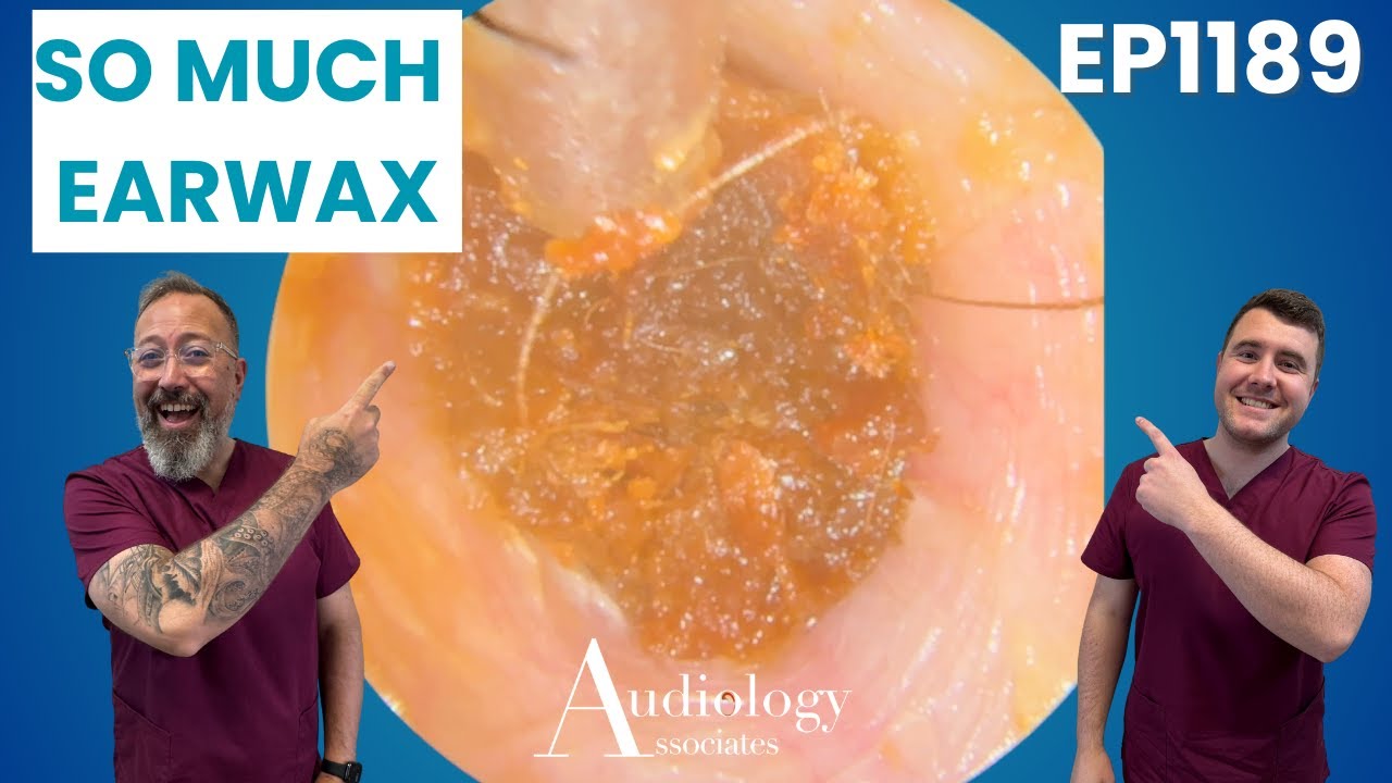 Gross but Satisfying! Deep Ear Wax & Skin Removal - EP1189 - YouTube