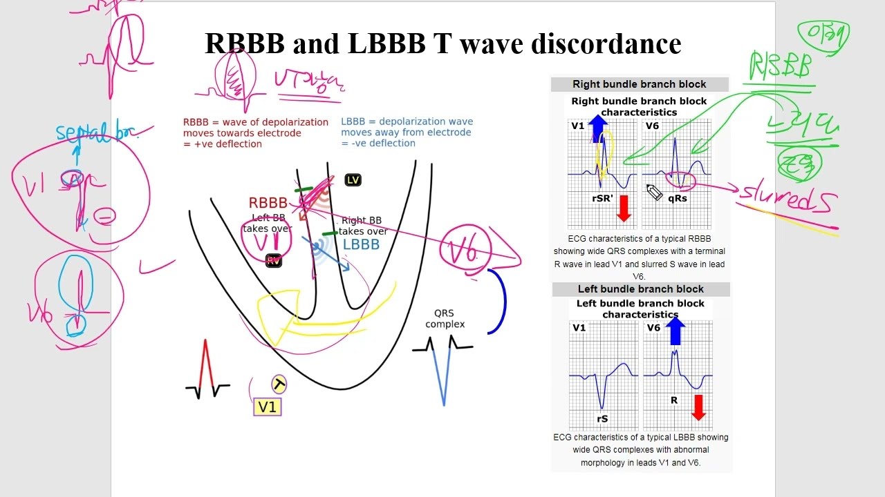 김교수 스타일로 RBBB, LBBB를 이해해보자 [김교수 심전도 7강] - YouTube