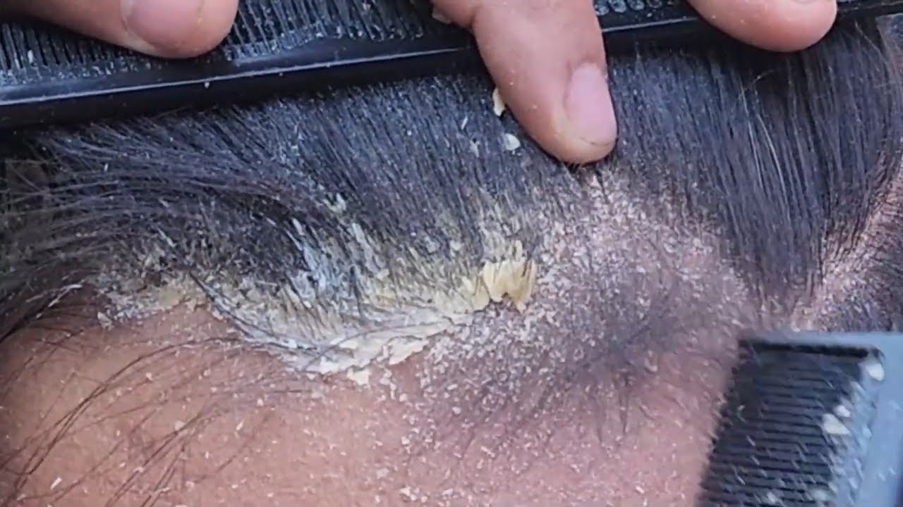 ASMR Scalp Scratching for Sleep and Relaxing Care #802 - YouTube