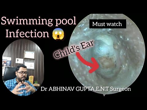 Microsuction Magic: Clearing Swimmer's Ear Infection in a Child| - YouTube