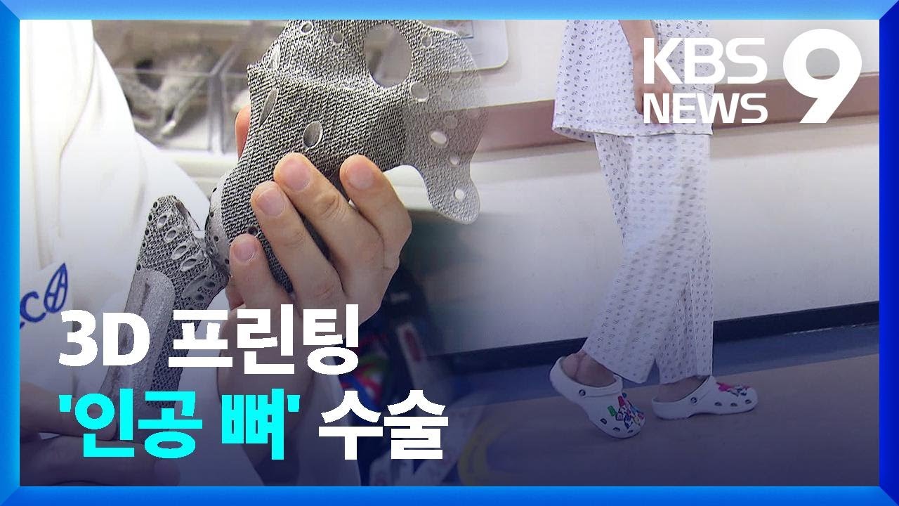 3D프린팅 인공 뼈 수술…“이젠 걸을 수 있어요” [9시 뉴스] / KBS 2023.01.19. - YouTube
