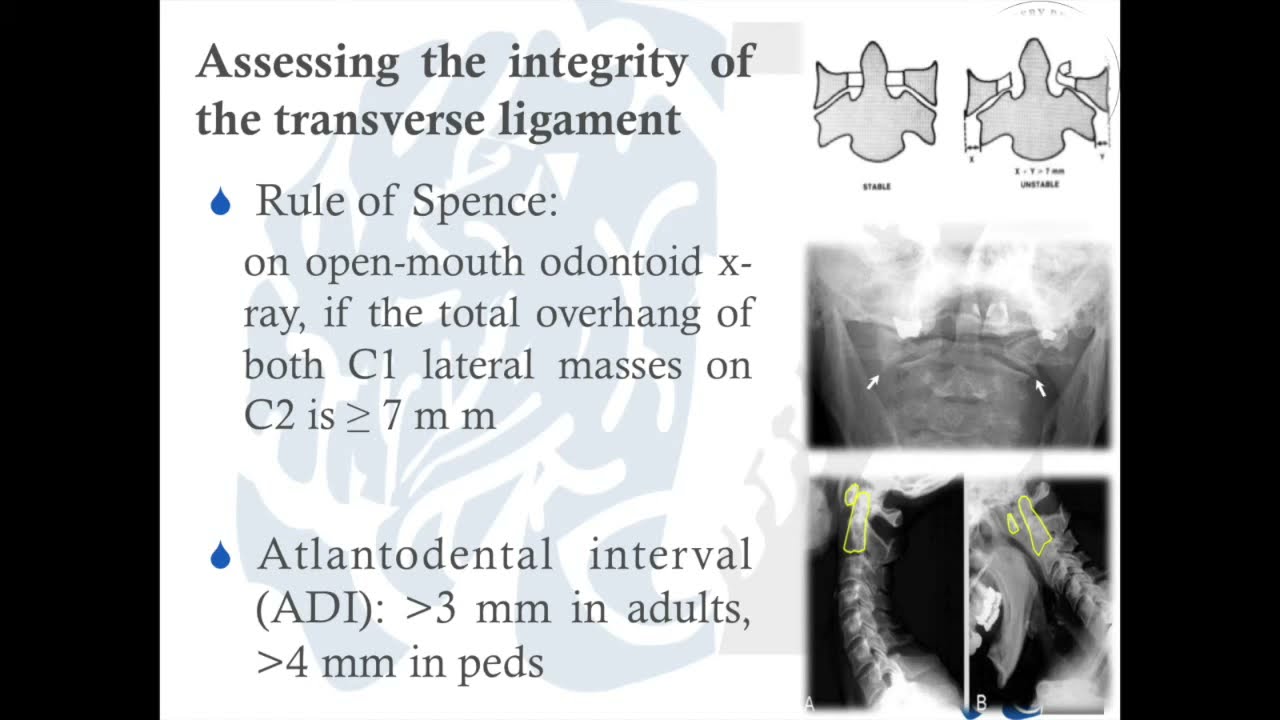 Spine Trauma (5): Anterior Atlanto-Axial Subluxation إصابات الفقرات ...