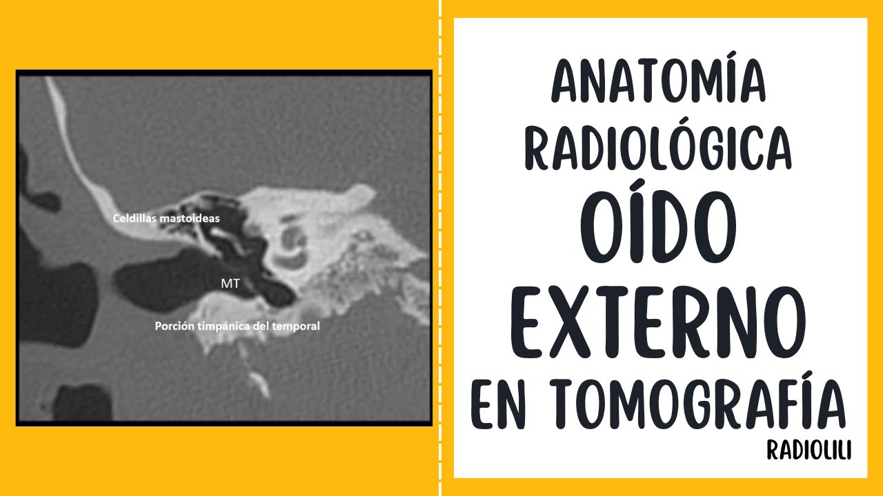 Radiología en 5 minutos: Anatomía radiológica del oído externo en ...