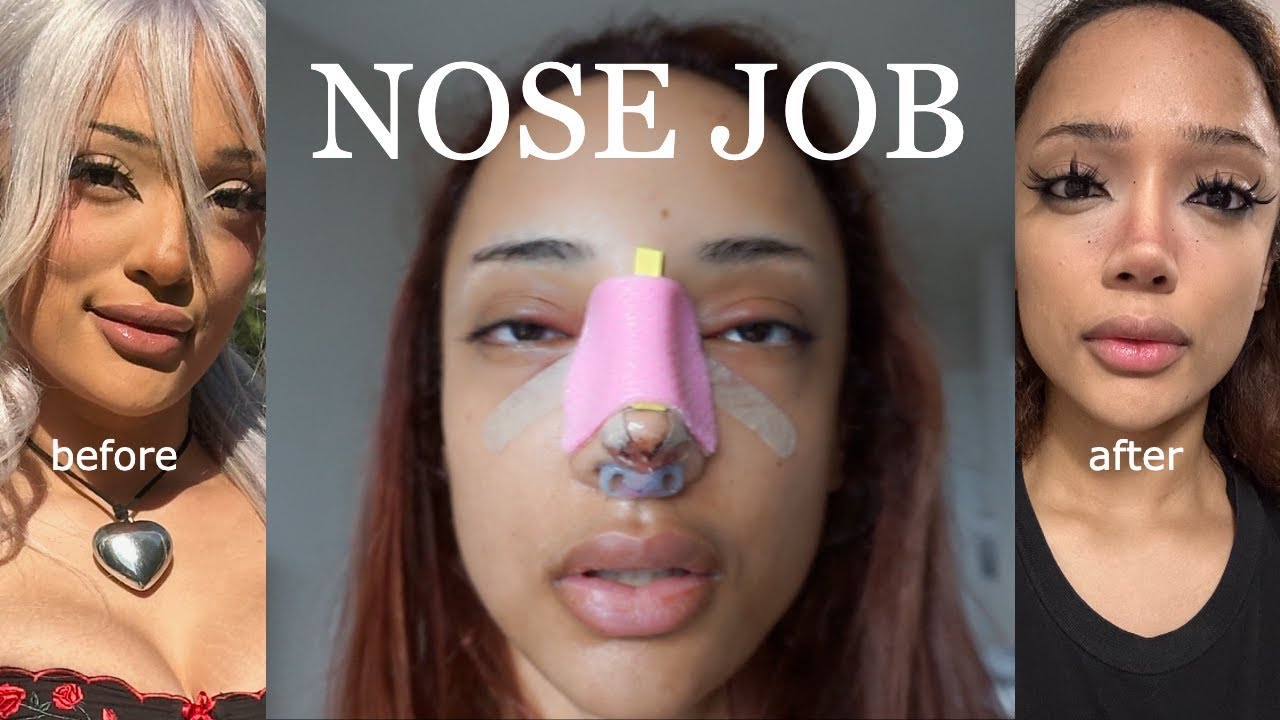 nose job vlog - 1 month update - YouTube