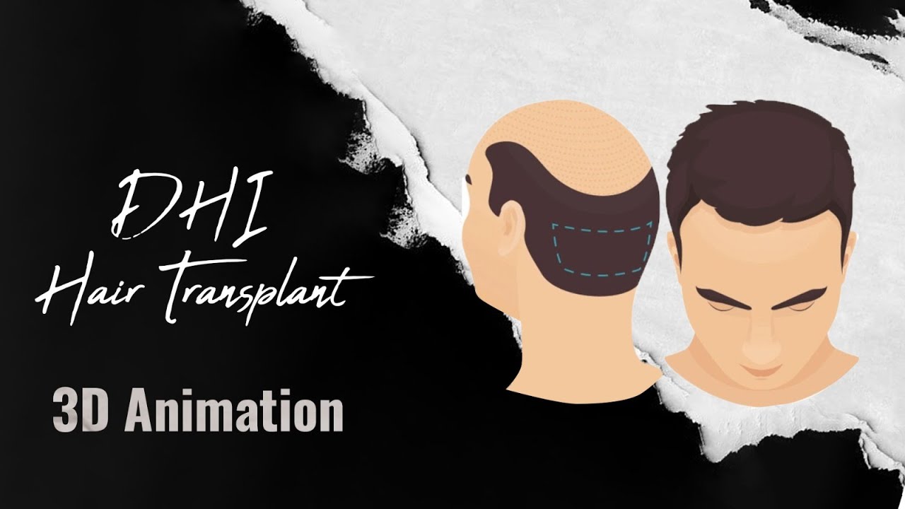 DHI Hair Transplant Explained | Direct Hair Implantation for Hair ...