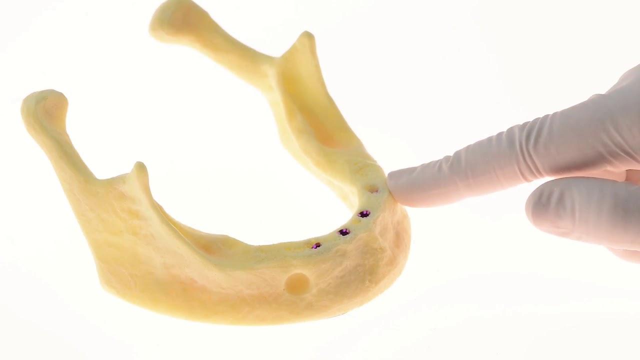 How to Perform the MIS MULTIFIX Procedure - YouTube