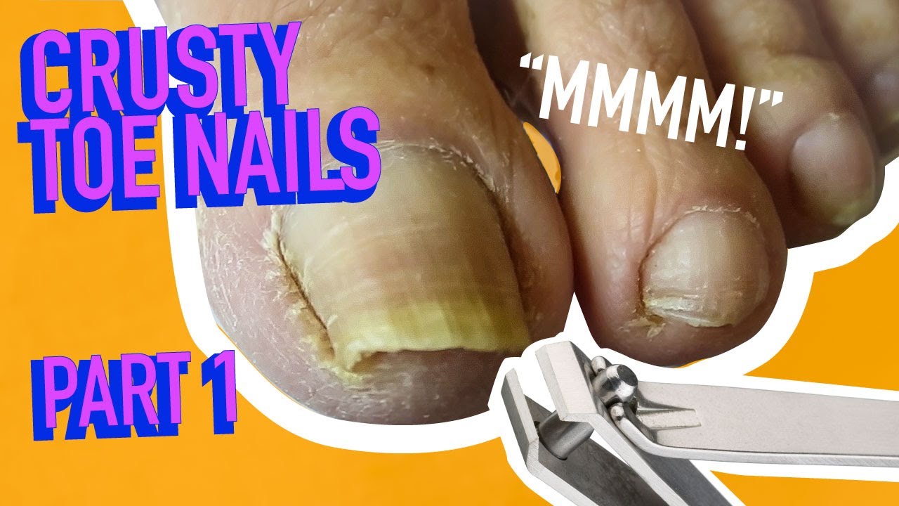 Satisfying Clipping & Cleaning SUPER CRUSTY TOE NAILS, pedicure, toe ...
