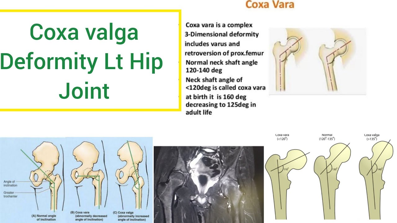 coxa valga deformity in left hip joint . - YouTube