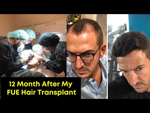 My Hair Transplant Update - 13 Month After FUE Transplant in Turkey. Am I happy?? What went wrong!