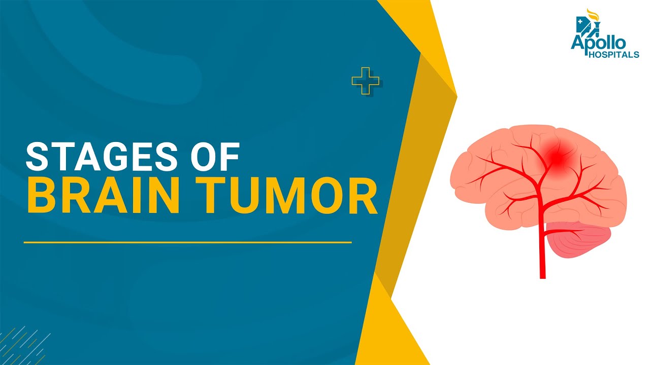 Insightful Guide to the Stages of Brain Tumor | Dr Alok Ranjan ...