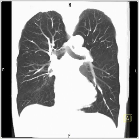 Lung Anatomy: Bronchoalveolar Cell Carcinoma (3 of 3) - YouTube