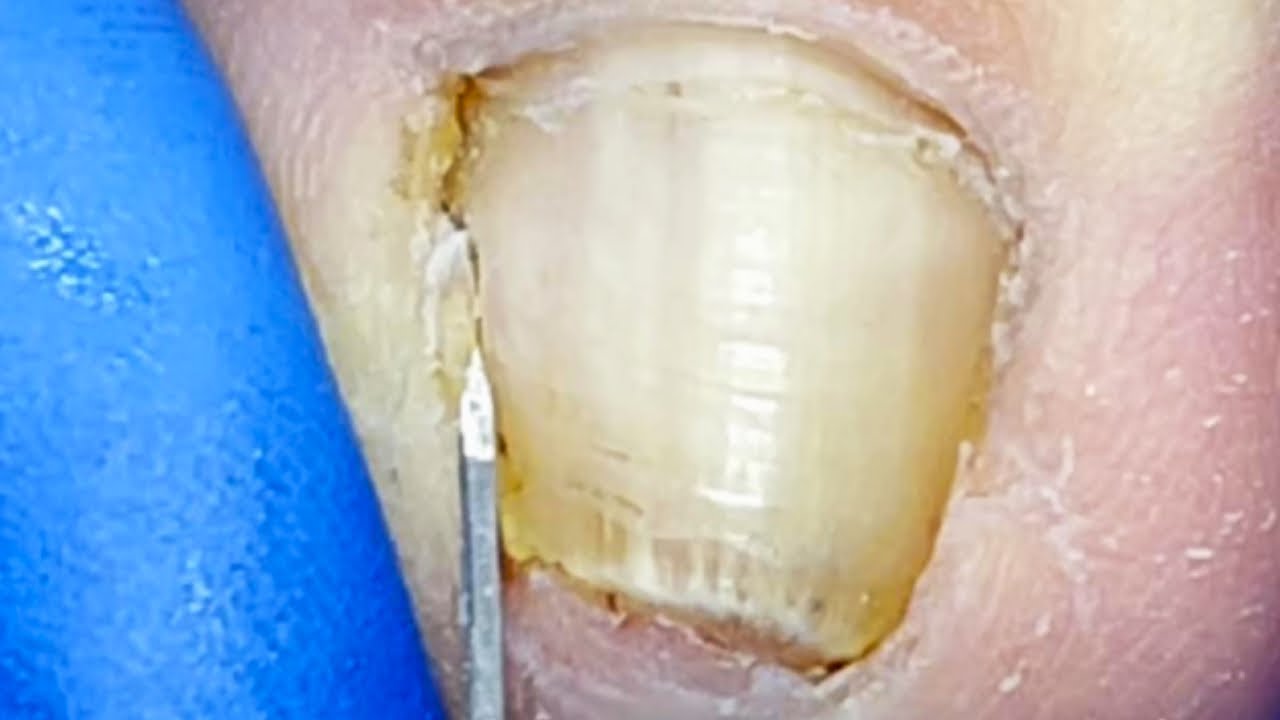 Nails hidden deep in toenails, trimmed - YouTube