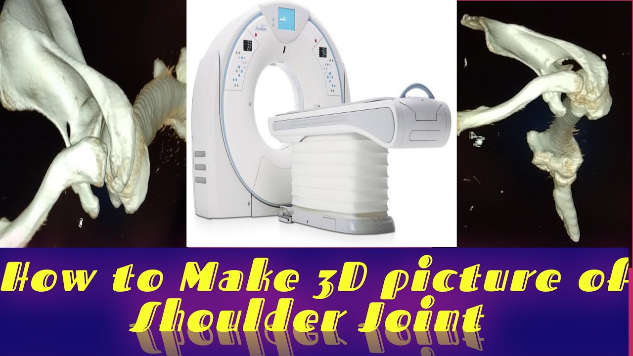 3D Picture of Shoulder Joint CT Scan | CT Scan Shoulder Joint 3D ...