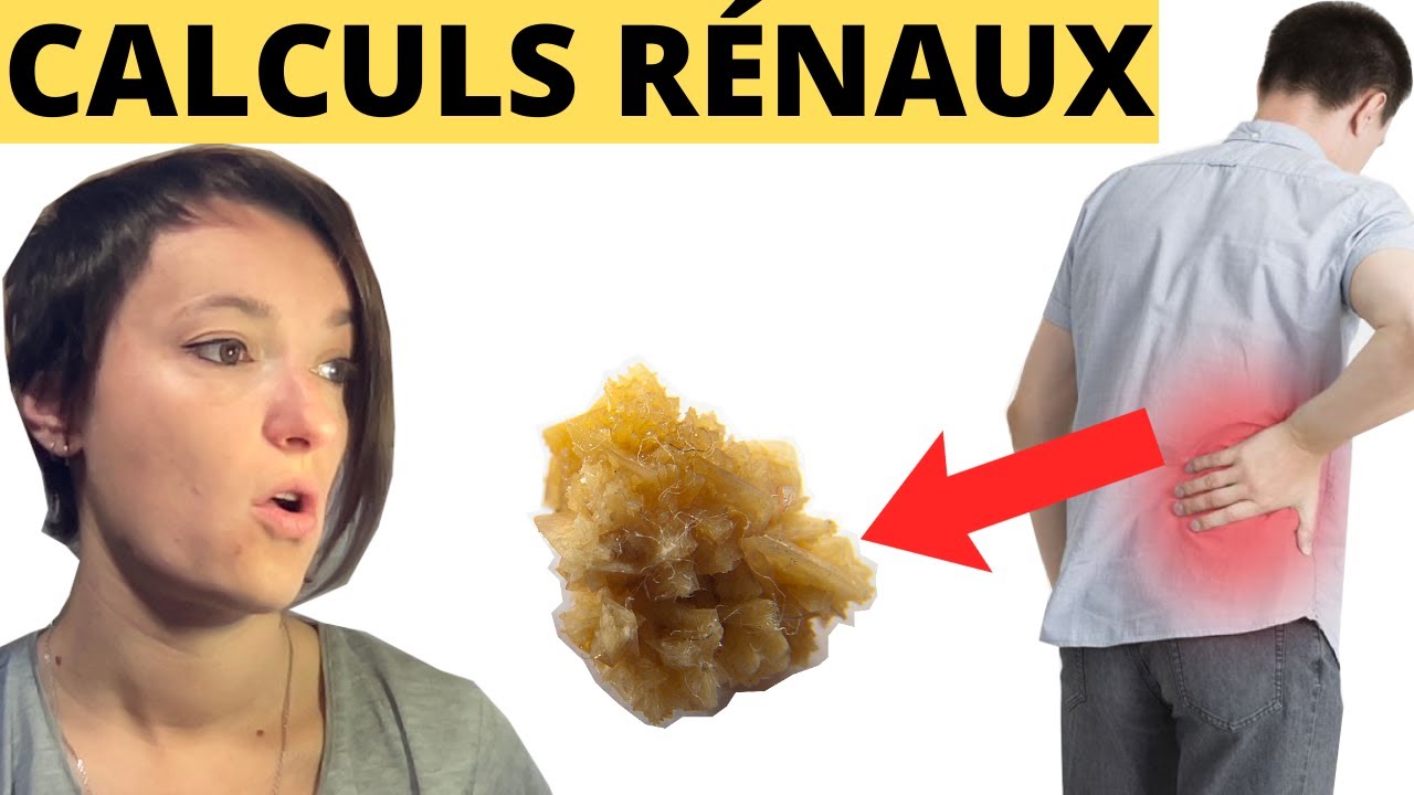 Calculs Rénaux: Causes, Symptômes et Remèdes Naturels - YouTube