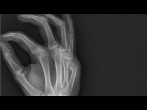 Metakarp boksör kırığı ameliyatı öncesi ve sonrası - YouTube