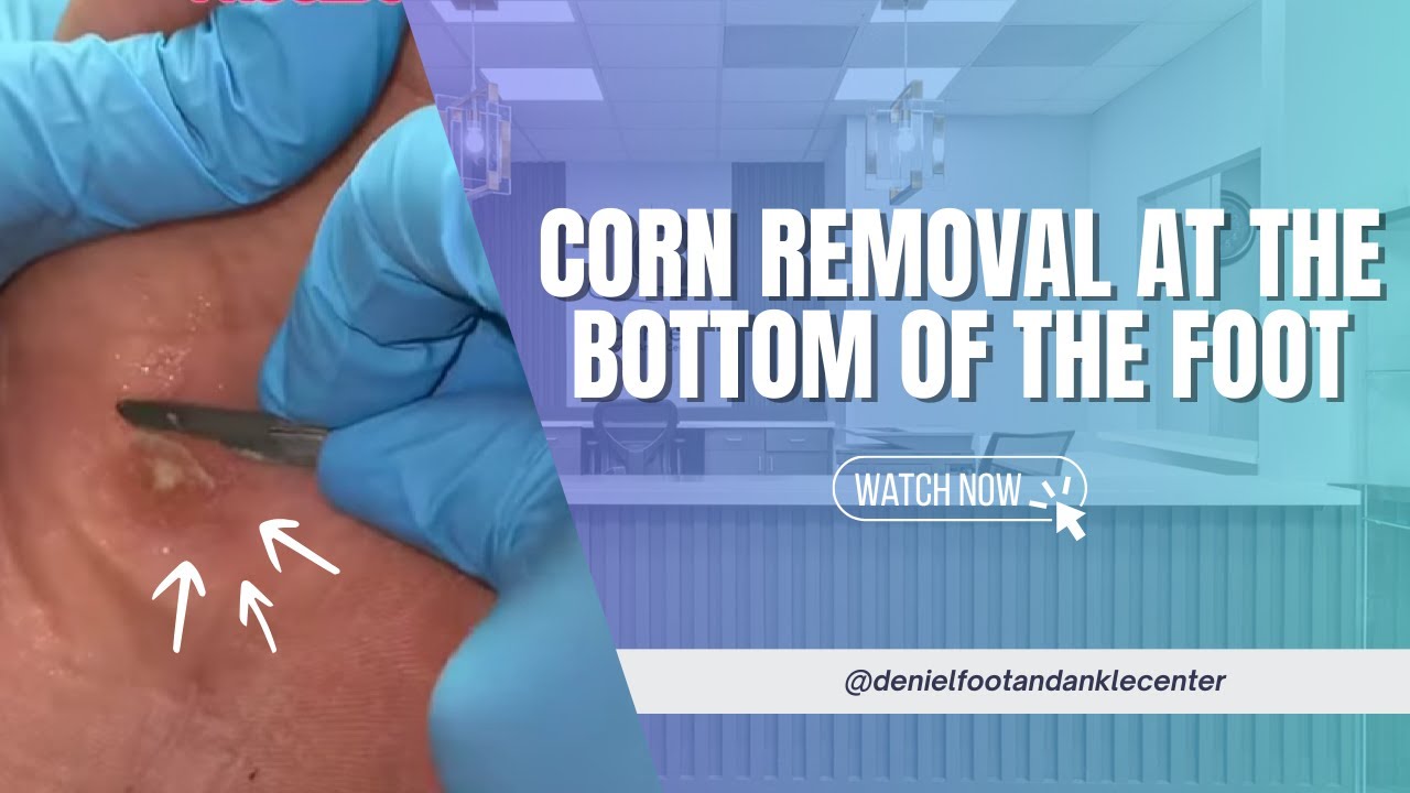 Corn Removal from the Bottom of the Foot | Podiatry Procedure - YouTube