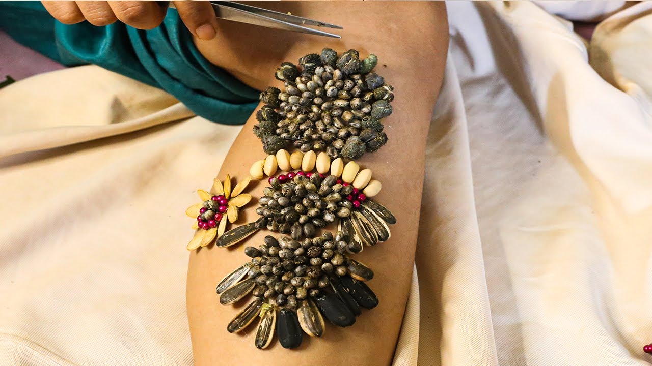 Amazing Million of Ticks Remove #1063 - YouTube