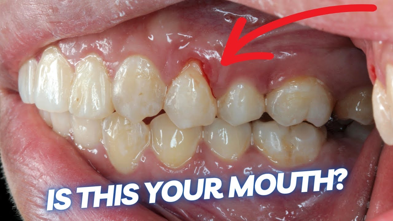 Understanding Gum Recession: Causes and Natural Solutions - YouTube
