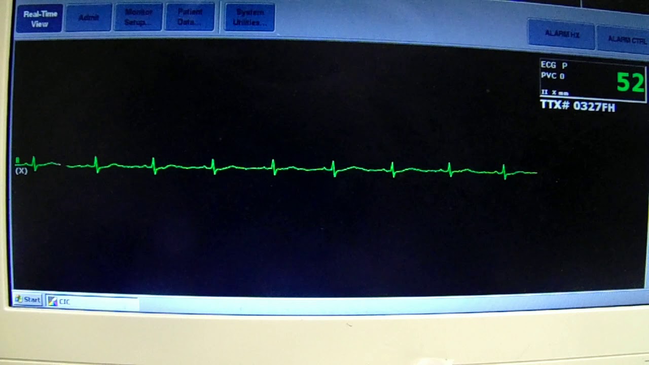 Sinus Bradycardia Heart Monitor Visual TUTORIAL - YouTube