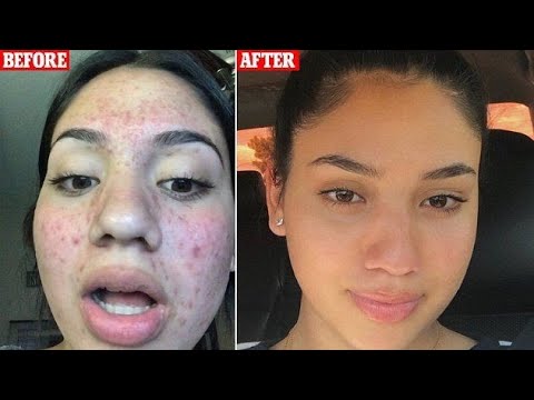 Acne problem permanent solution - YouTube