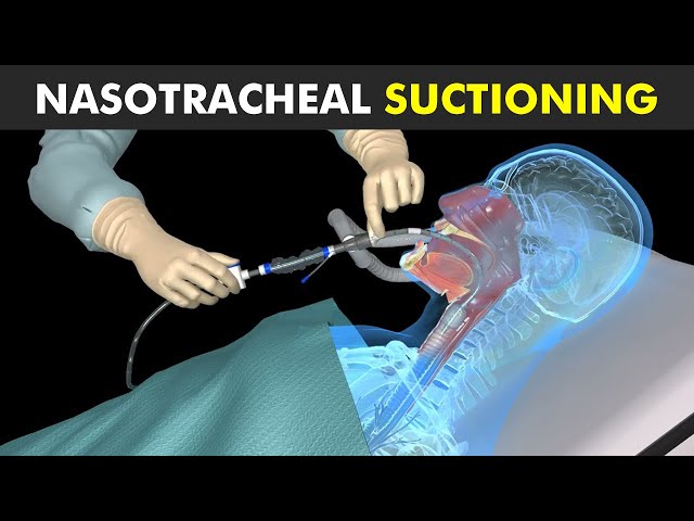 nasotracheal-suctioning-technique