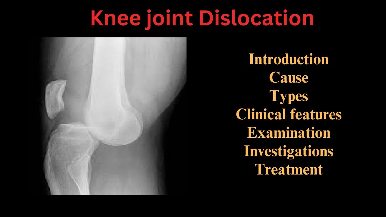 Knee joint dislocation: Causes, Types, Clinical features, Examination ...