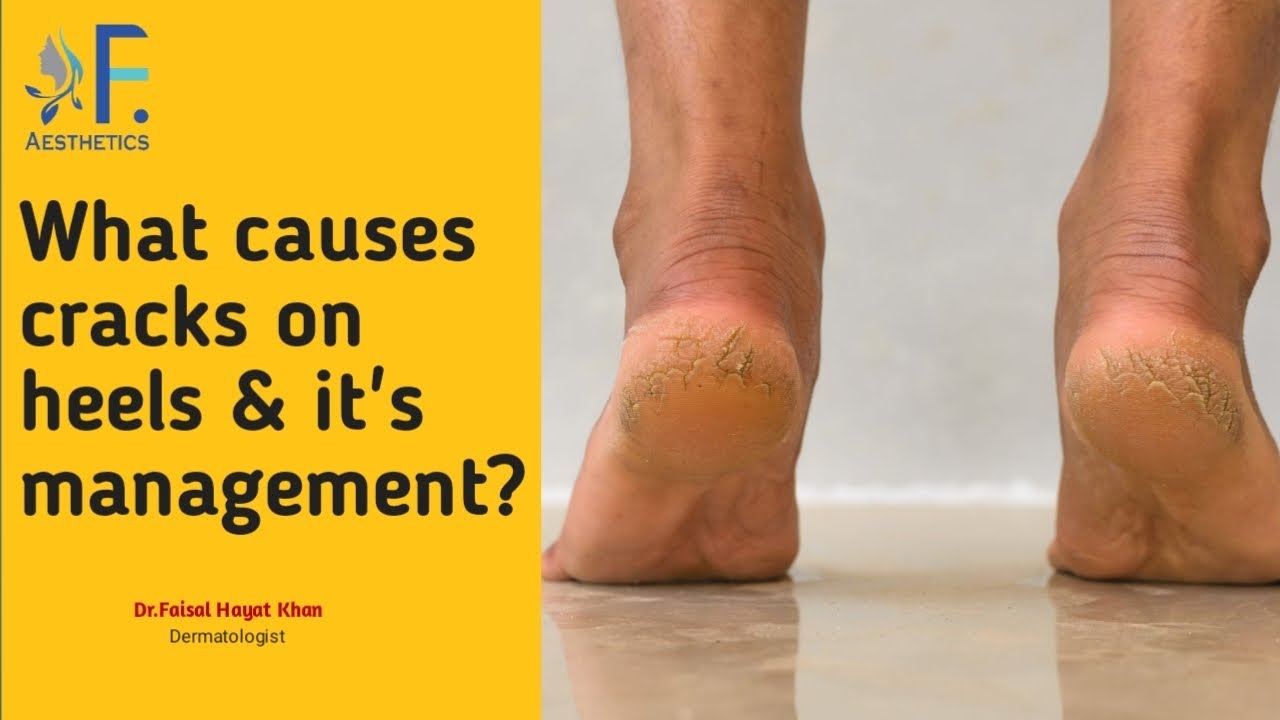 What causes cracks on heels & its management? Dr.Faisal Hayat Khan ...