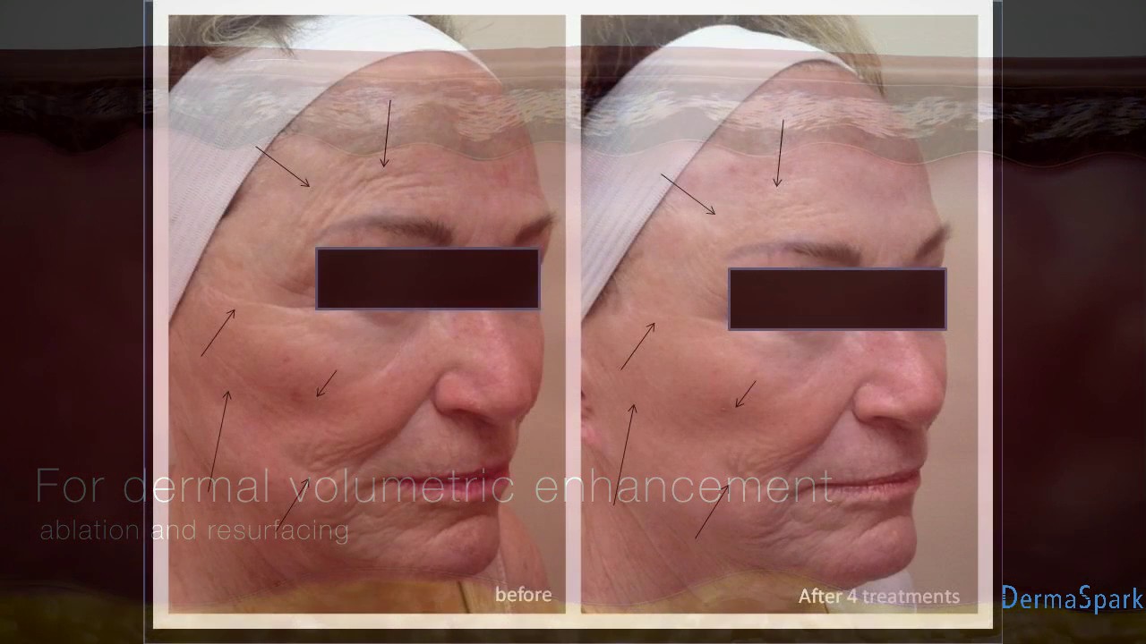 Pollogen VoluDerm Treatment at Glow Medi Spa - YouTube
