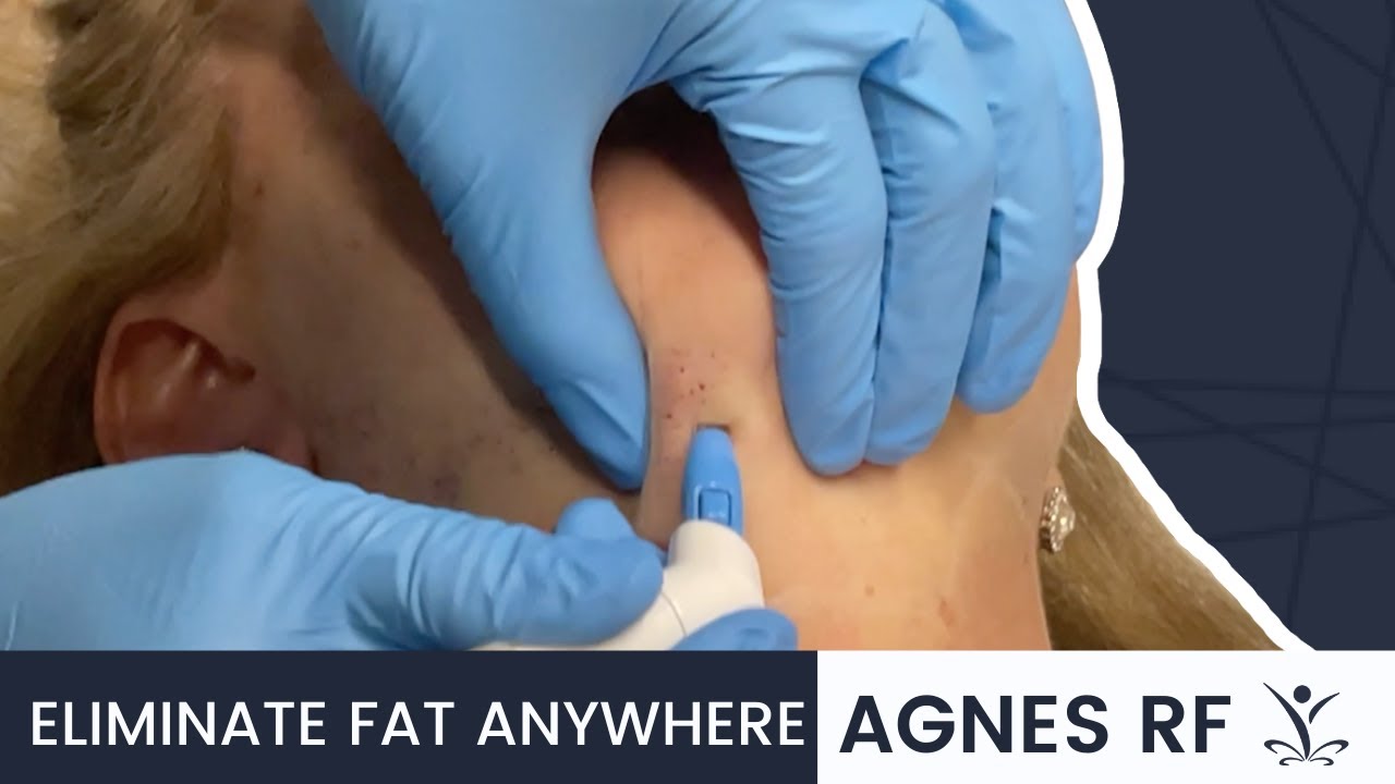 Agnes RF Microneedling, an Alternative to Surgery - YouTube