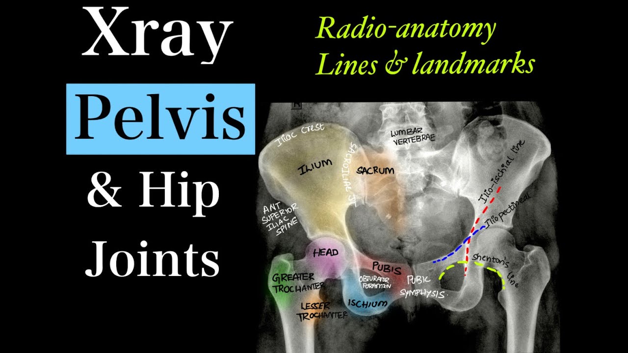 X-ray Pelvis & B/L hip l Anatomyl Viewsl Linesl Landmarksl ...