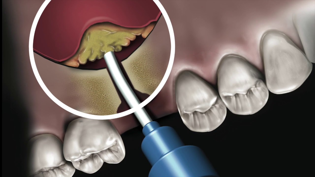MITSA With Densah by Dr. Udatta Kher | NovaBone Dental Products - YouTube