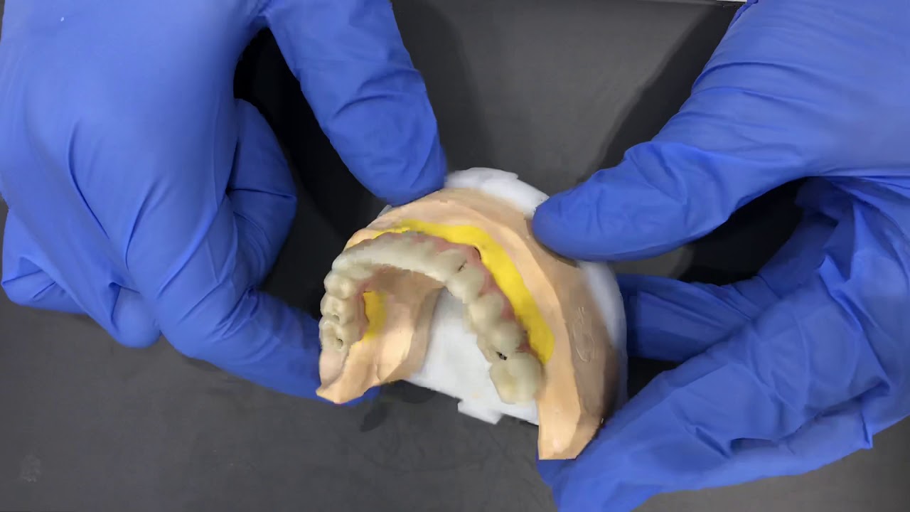 Modified screw retained bridge on implants - YouTube