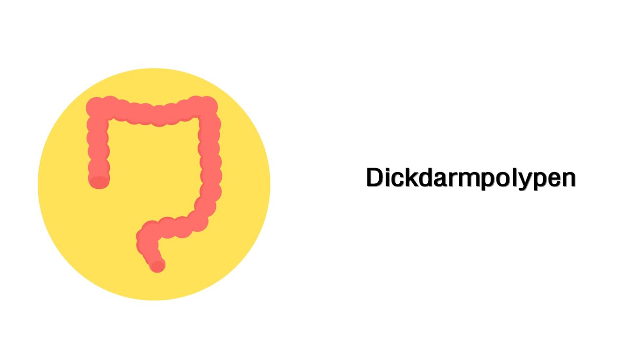 Dickdarmpolypen (Colonpolypen) - Erkrankungen des Verdauungssystems ...