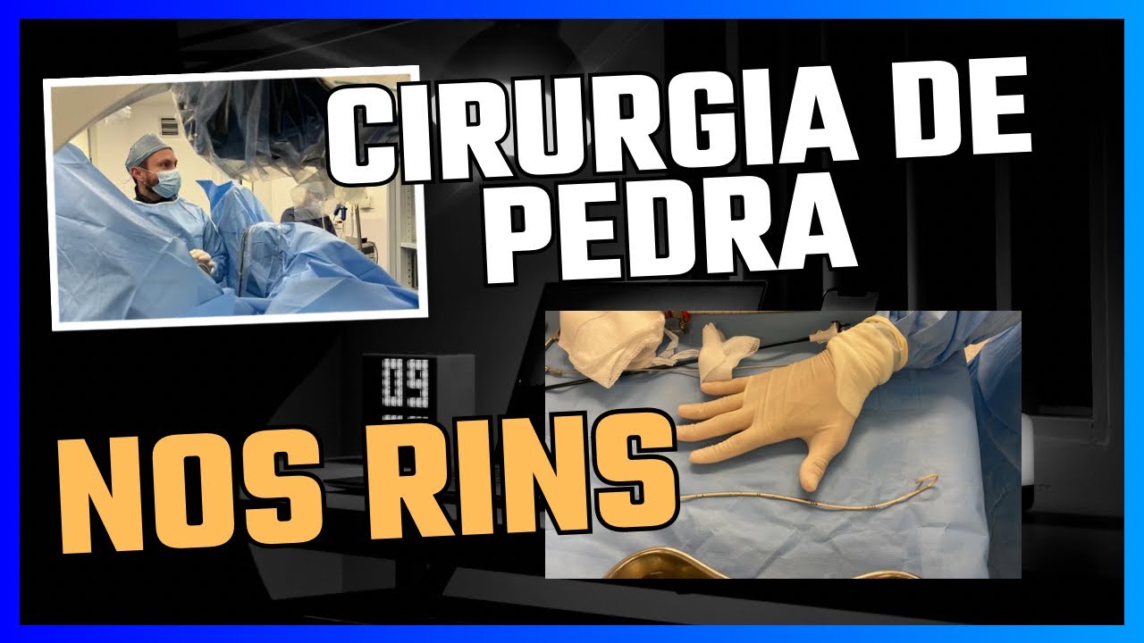 Passo a passo da cirurgia de pedra nos rins. Veja tudo. - YouTube
