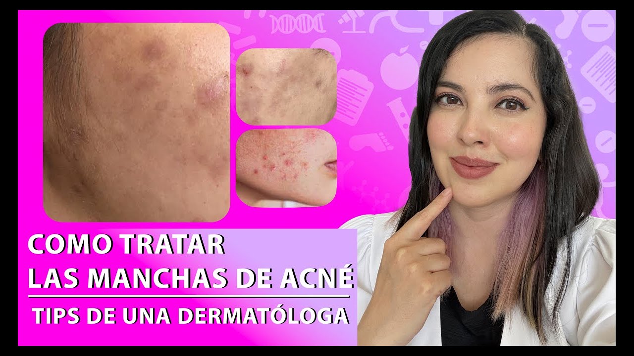 ¿tienes Manchas Por AcnÉ Tips De Una Dermatóloga 👩🏻⚕️👌🏻 Youtube