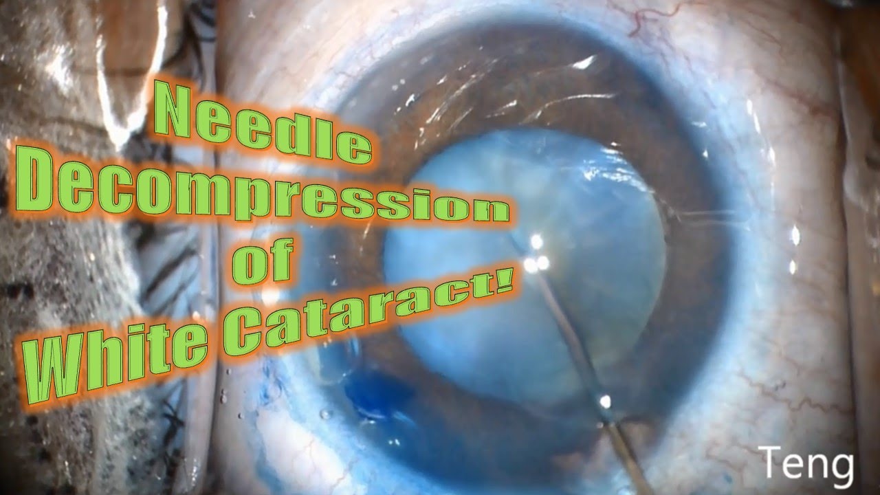 How to Perform Needle Decompression to Prevent Argentina Flag Sign ...