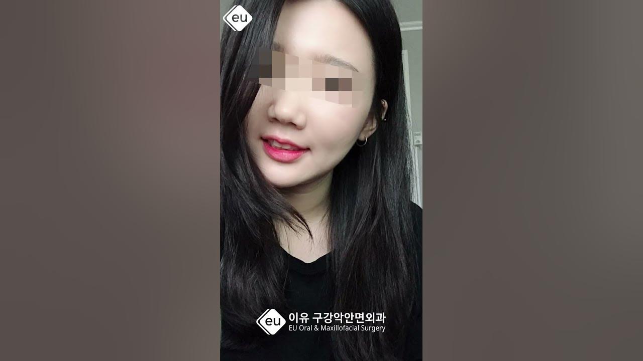 양악수술and브이라인수술 전후 Shorts Youtube