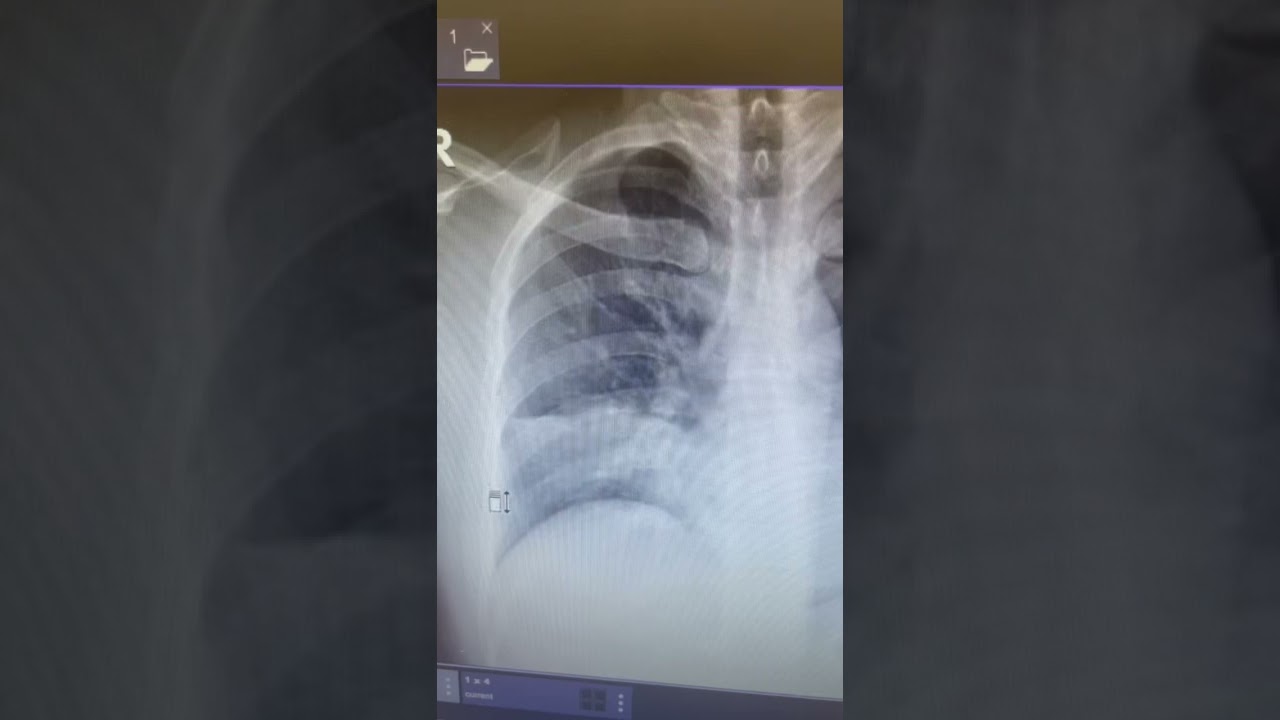 Chest X-Ray of Right middle lobe Pneumonia #radiology #chestxray # ...