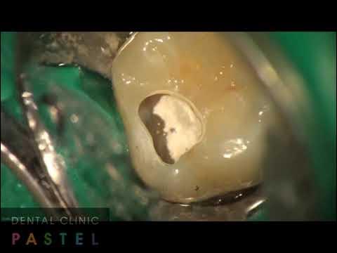 Direct pulp capping with Well-Root PT - YouTube