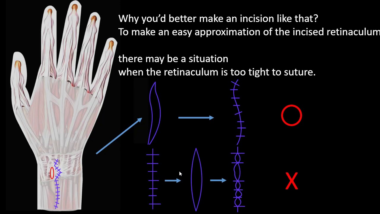 Wrist Dorsal incision of retinaculum - YouTube