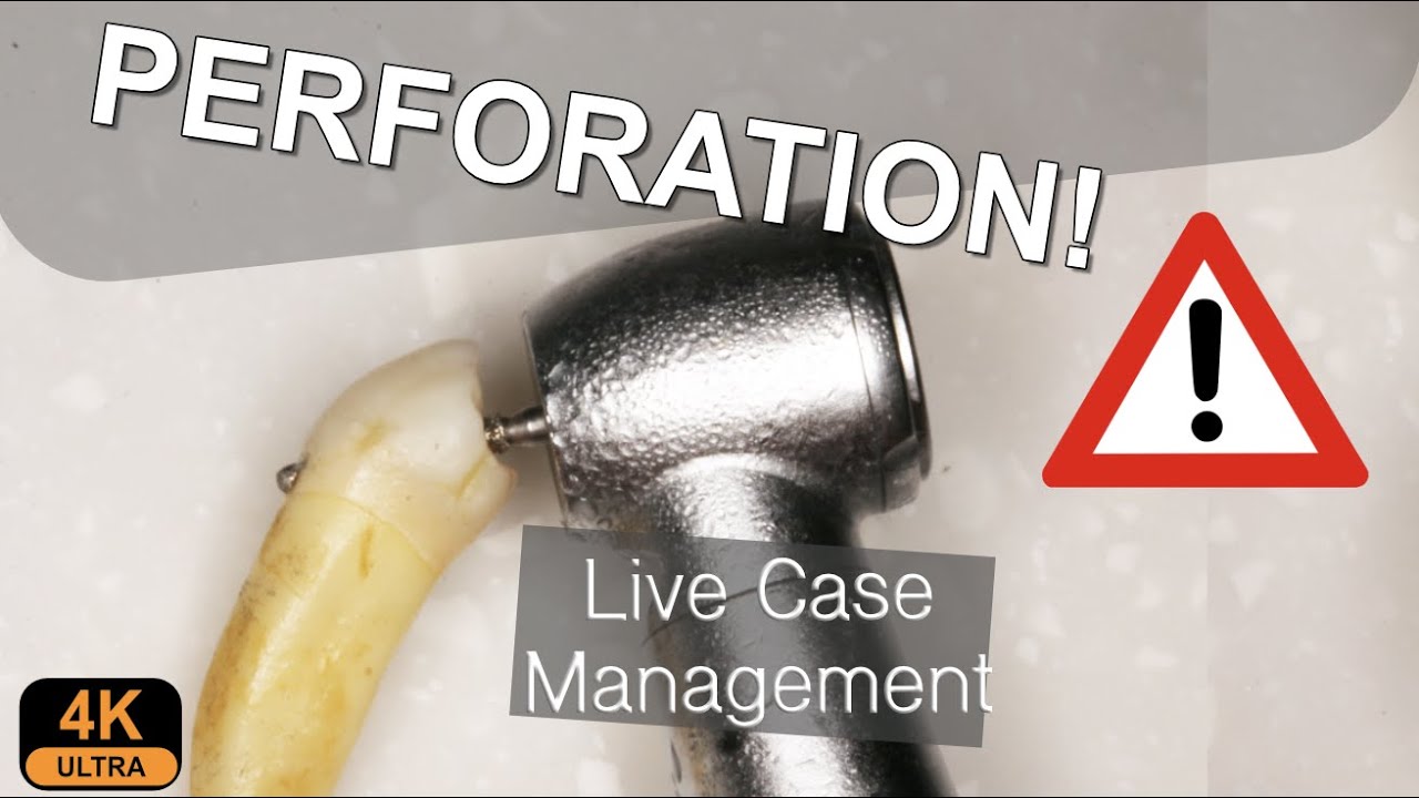 TOOTH PERFORATION MANAGEMENT | 4K Resolution - YouTube
