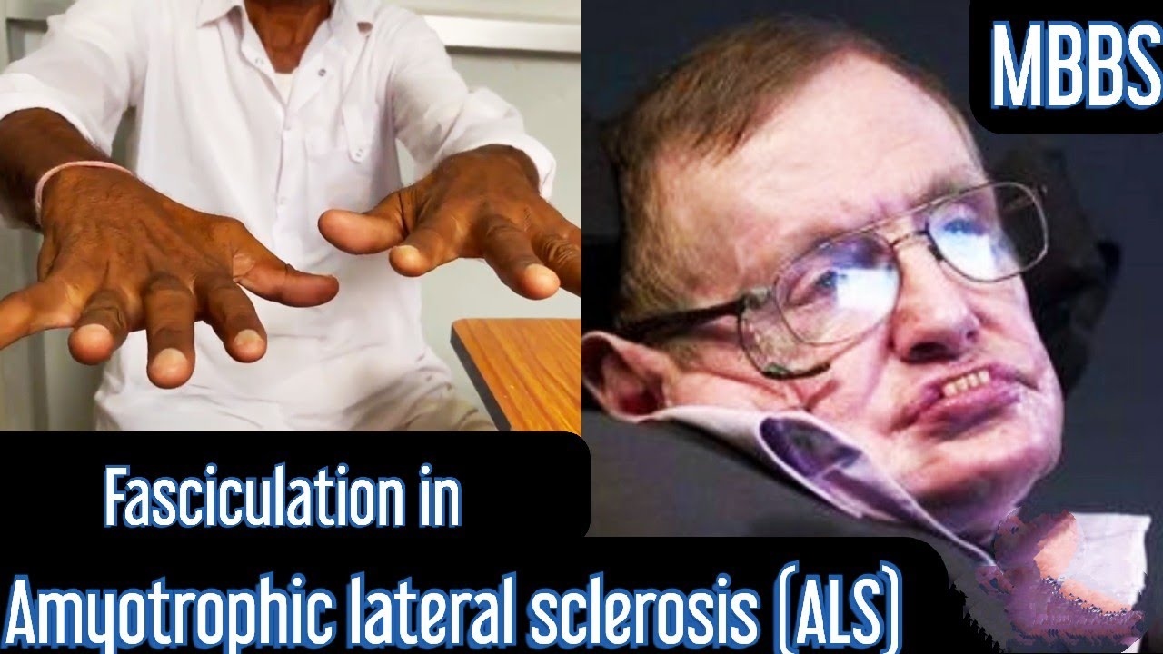 Fasciculation in Amyotrophic lateral sclerosis (ALS) #mbbs #medicine # ...