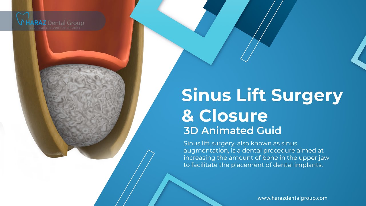 Sinus Lift Surgery & Seamless Closure: HARAZ Dental Group - YouTube