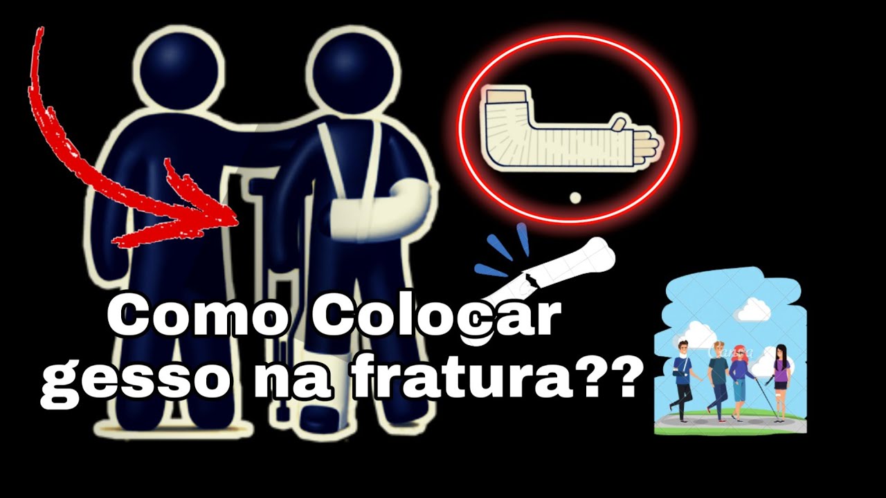 Imobilização de Fratura com Gesso - ORTOPEDIA - YouTube