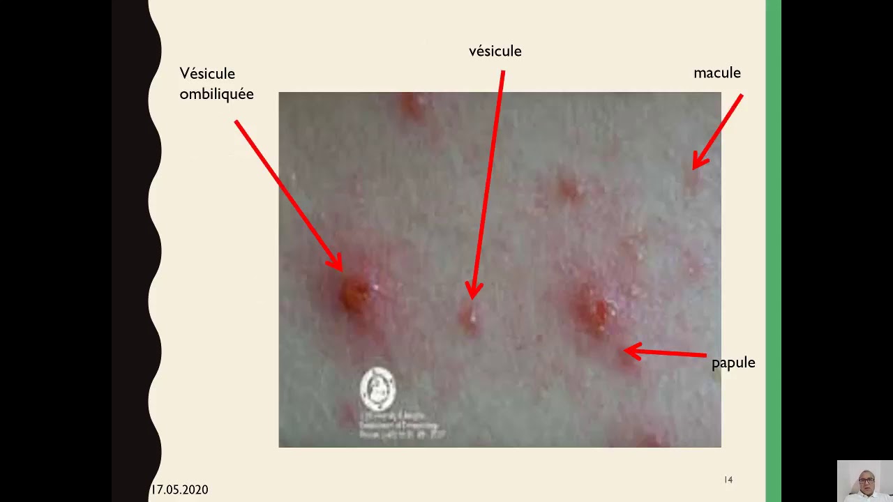 Les Viroses Vésiculo-Pustuleuses - Dr Mohamed Zeroual - YouTube