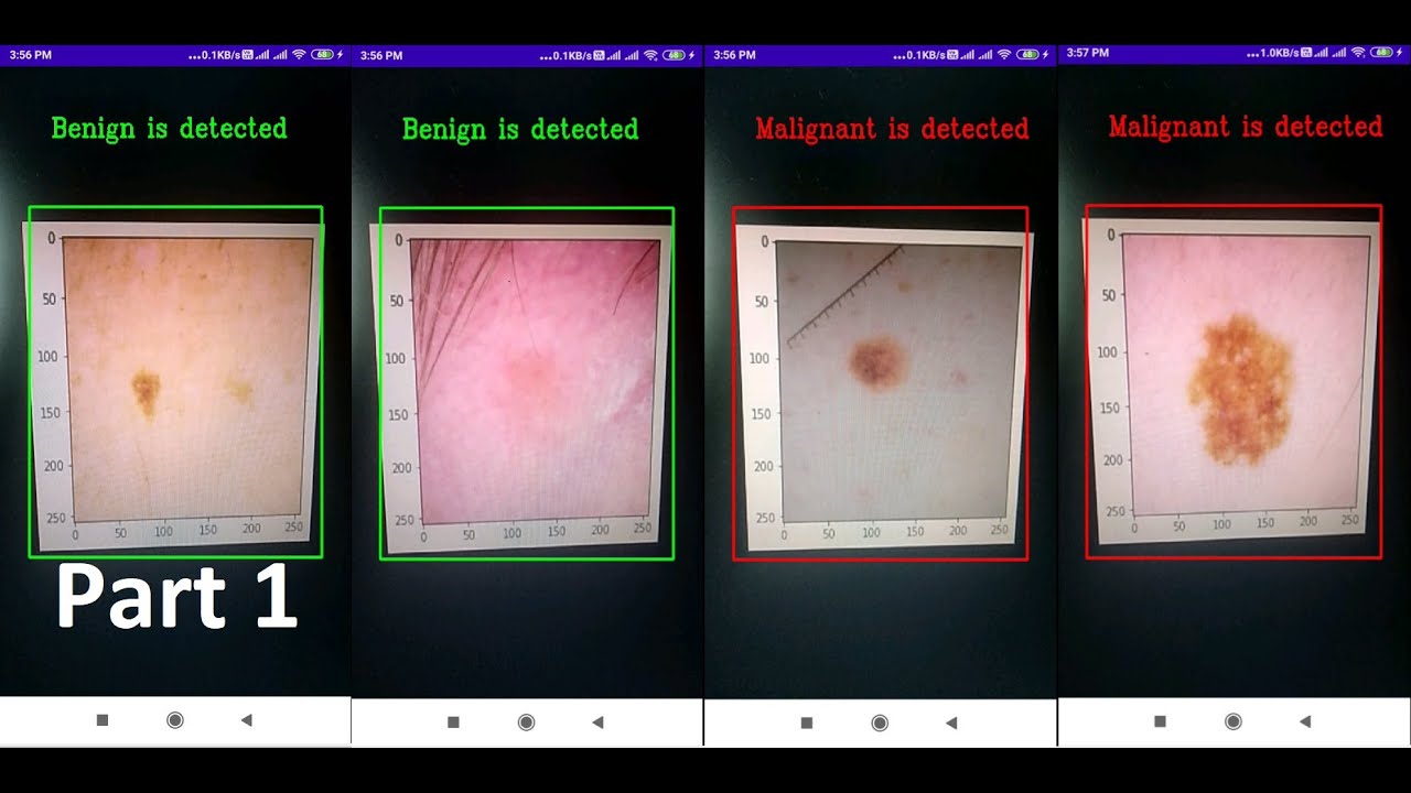 Real-time Skin Cancer (Melanoma) Detection Android App Using TFLite ...